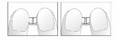 VASOXEN 5 mg 84 tablet Nasıl Kullanılır